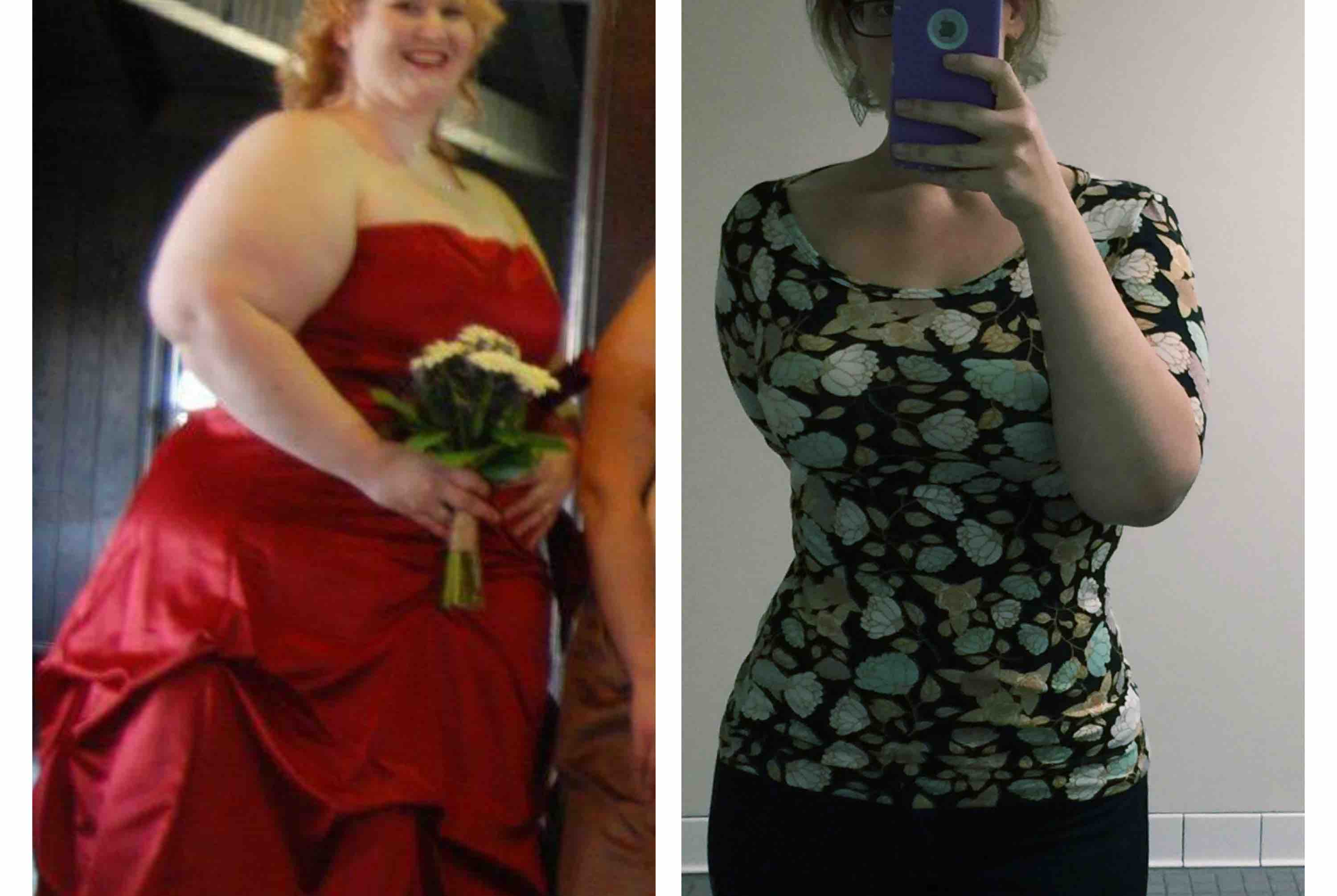 Fundraiser by Heather Bober Robuck : Thigh Skin Removal Surgery