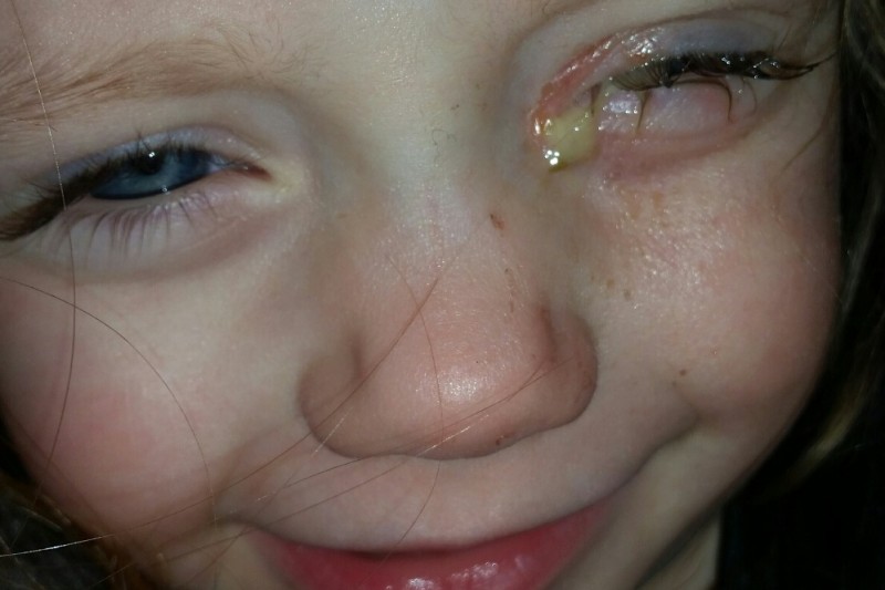 Fundraiser by Kelly Scalise : Save Aaliyah's Eyesight