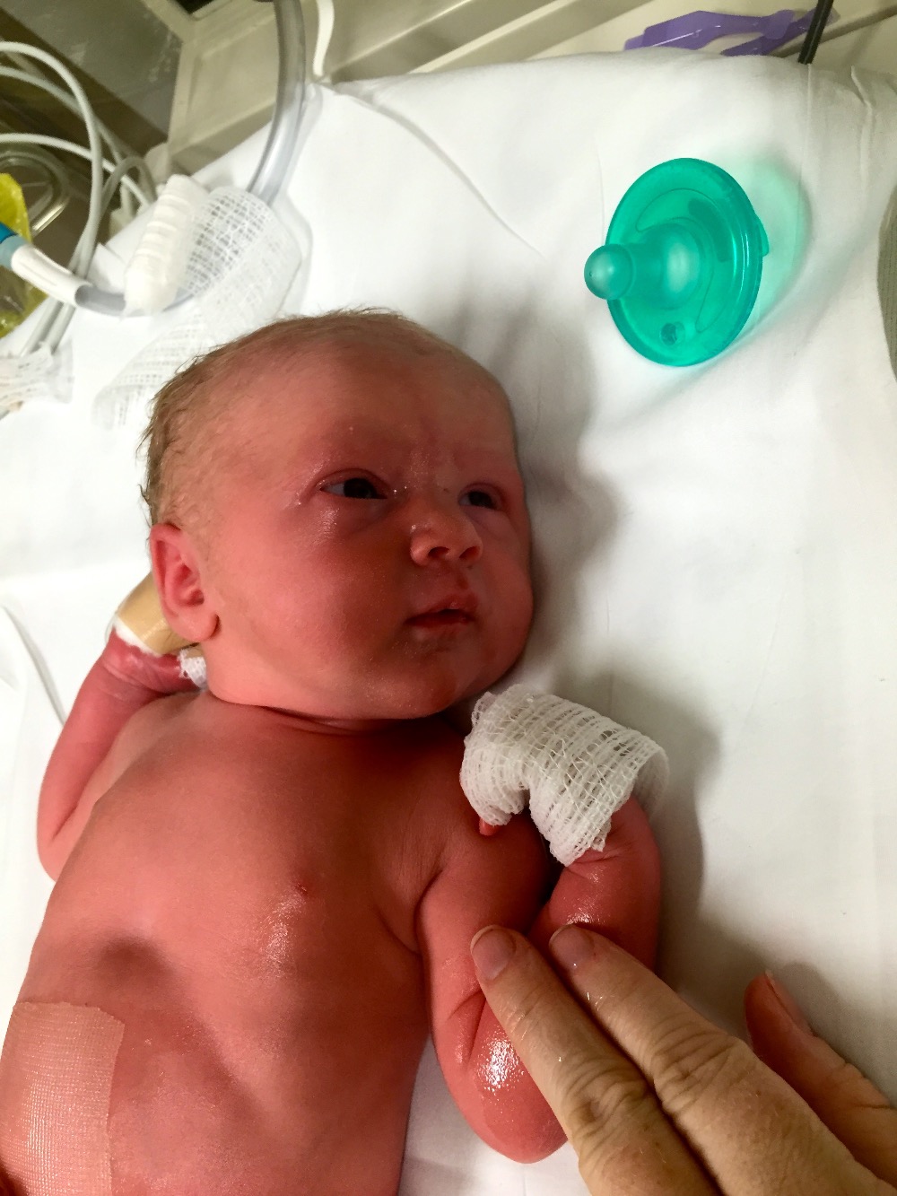 Epidermolysis Bullosa Newborn