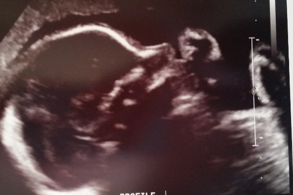 Fundraiser by Eric Jr. and Kristi Fox : Help Support Baby Brenna Fox