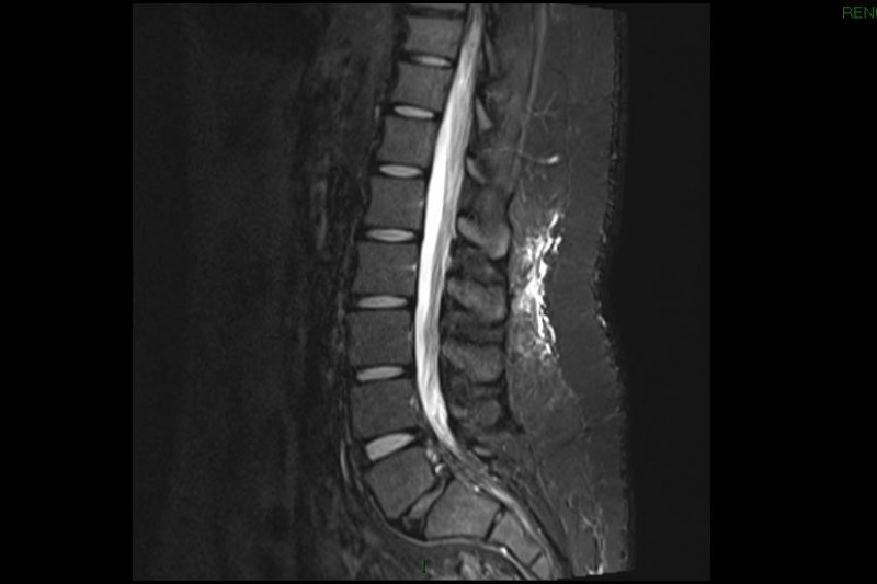 Fundraiser for Kinsey Neahusan by Katie Hubbard : Spinal Countdown ...