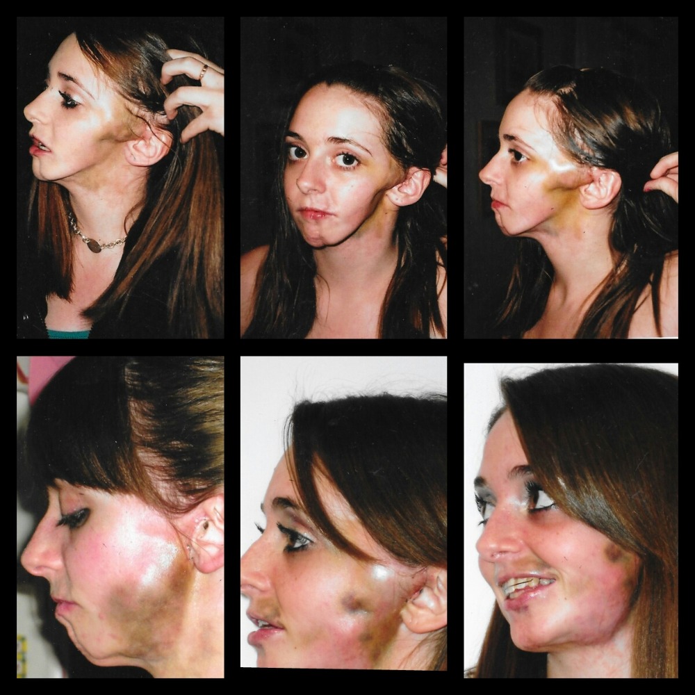 Fundraiser by Lori Tompkins : Annika's facial reconstructon